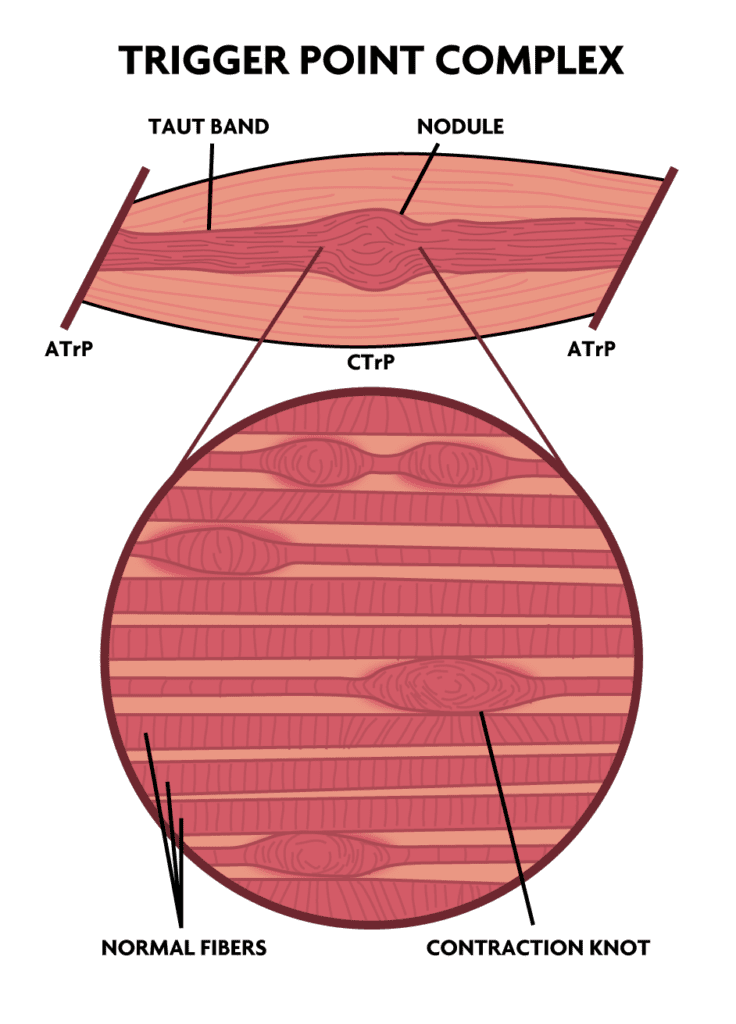 WHAT IS MYOFASCIAL RELEASE TRIGGER POINT THERAPY? – Peak Sport And ...