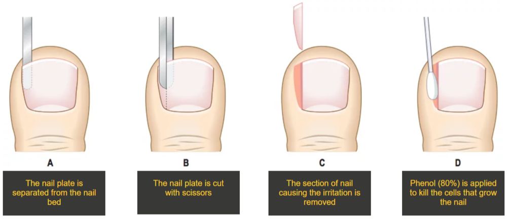 Understanding Ingrown Toenails – Peak Sport And Spine Centre