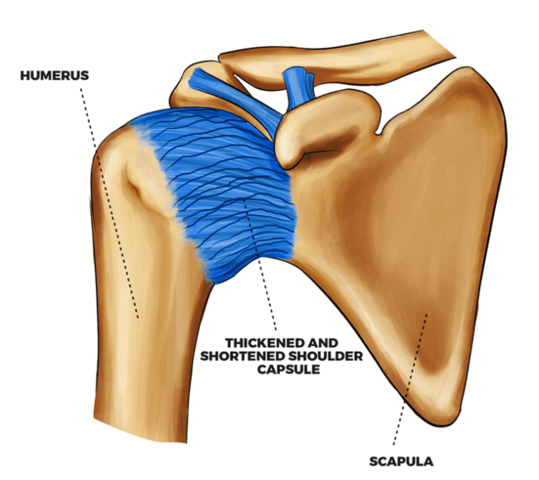 Frozen Shoulder - Adhesive Capsulitis – Peak Sport And Spine Centre