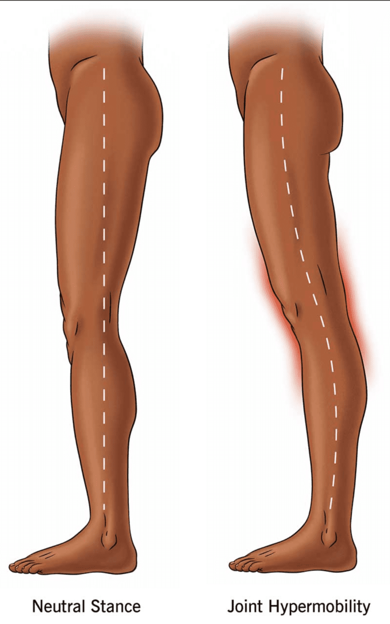 Understanding Hypermobility – Peak Sport And Spine Centre